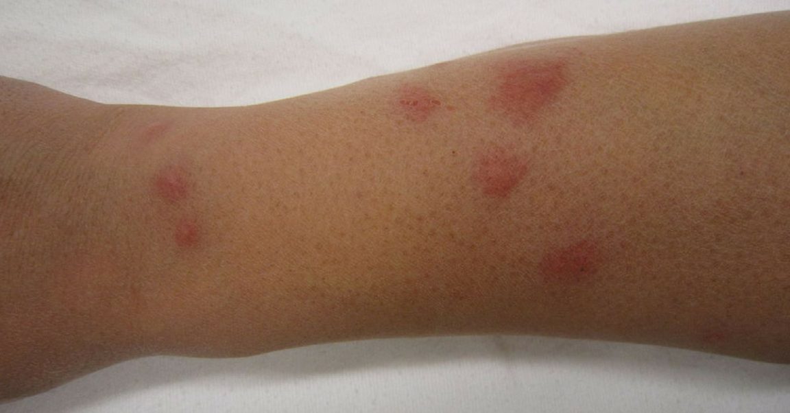 Pomadas para picada de inseto: quais são as melhores?