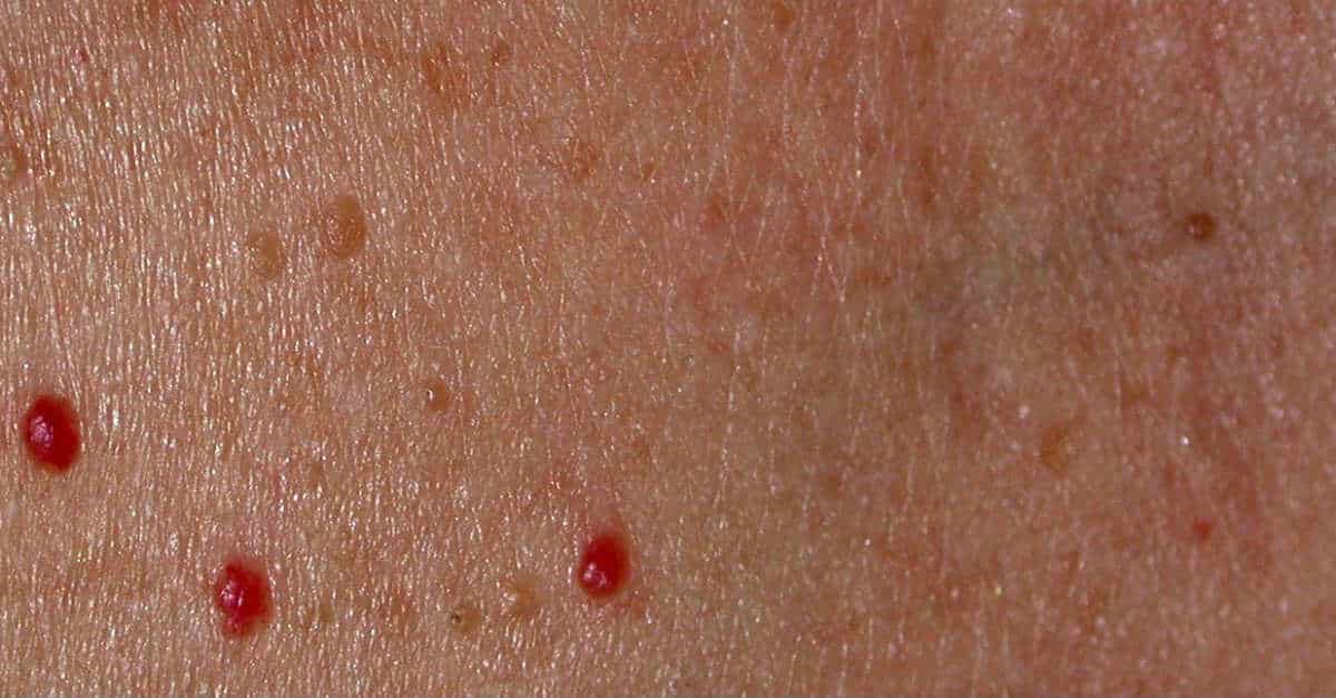 Pontos vermelhos na pele