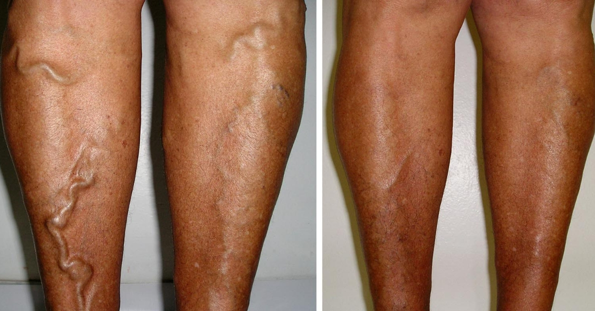 Conheça os melhores remédios caseiros para varizes