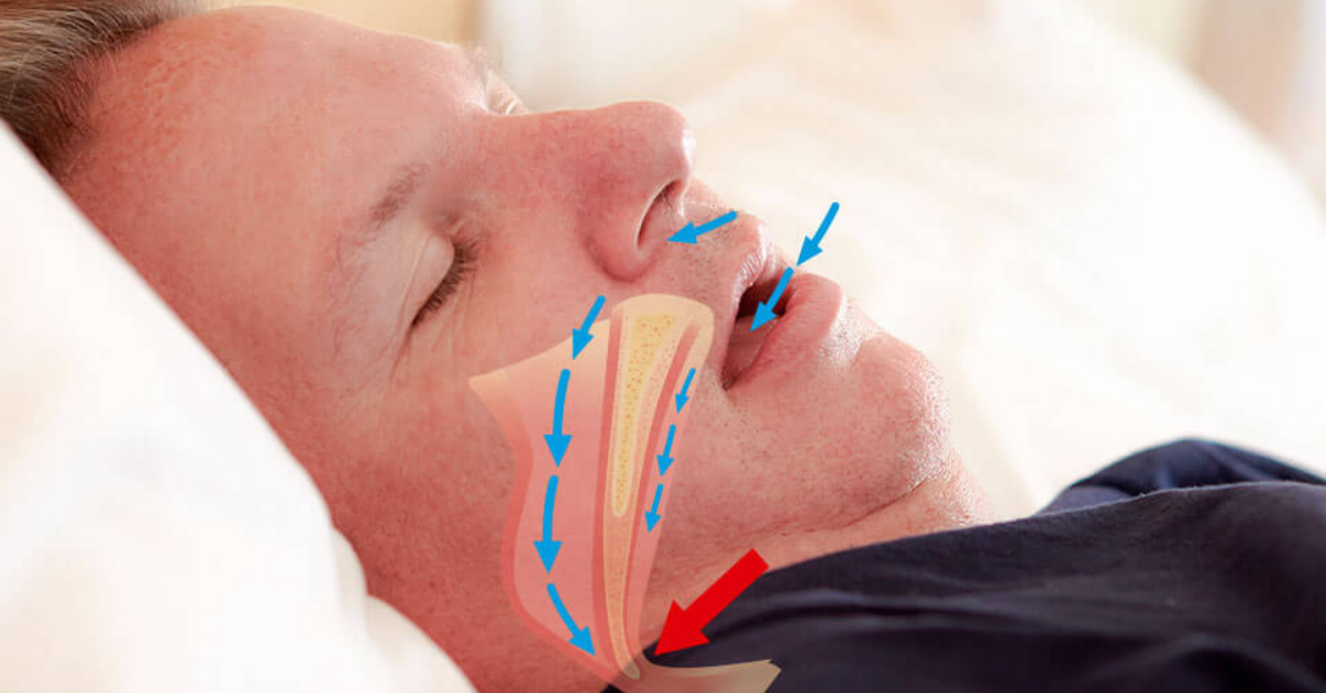 Quais doenças e condições que podem ter o ronco como sintoma?