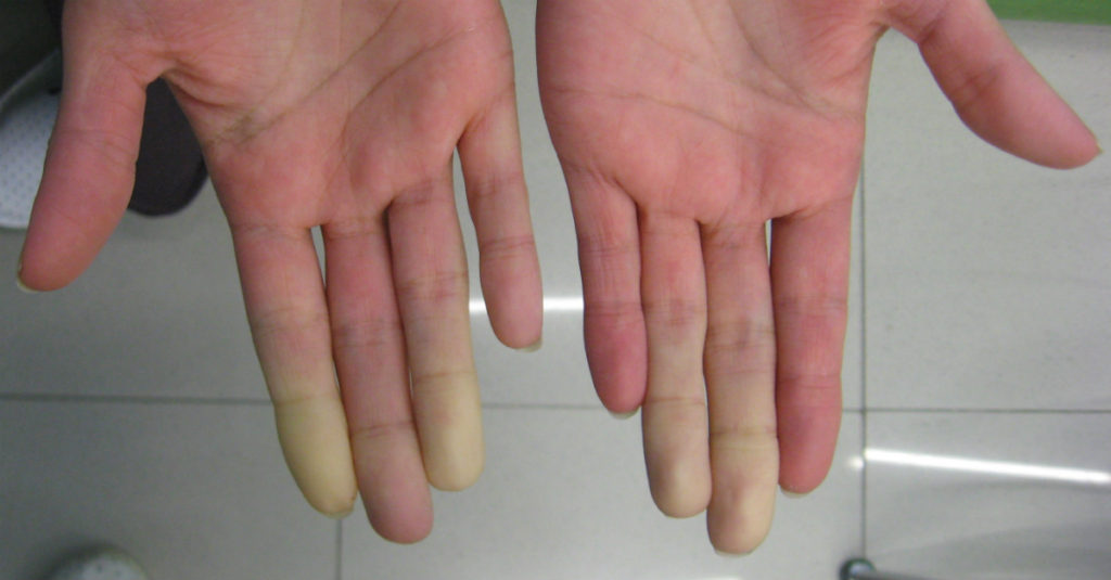 Síndrome de Raynaud: o que é e como evitar os sintomas