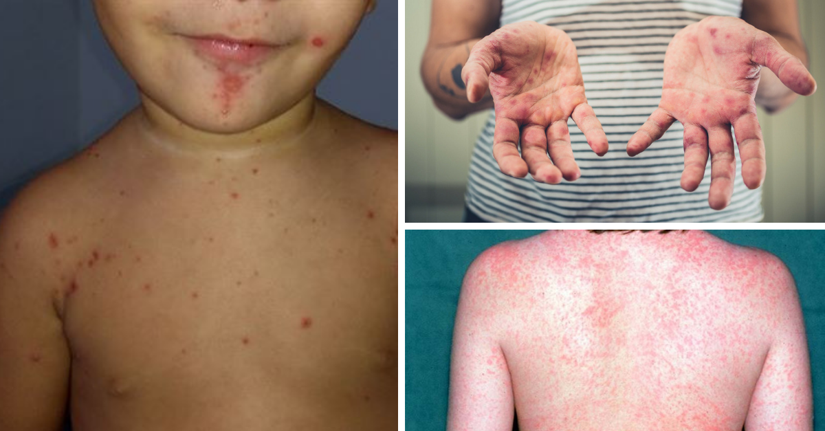 O que é, sintomas e tratamento da doença conhecida como sarampo