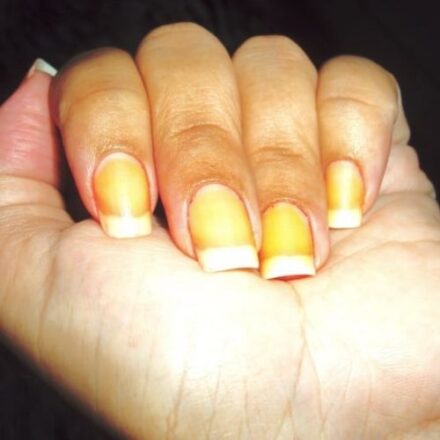O que as unhas dizem sobre a saúde? Veja 10 sinais de doenças