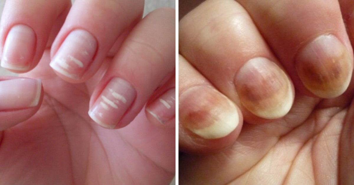 O que as unhas dizem sobre a saúde? Veja 10 sinais de doenças