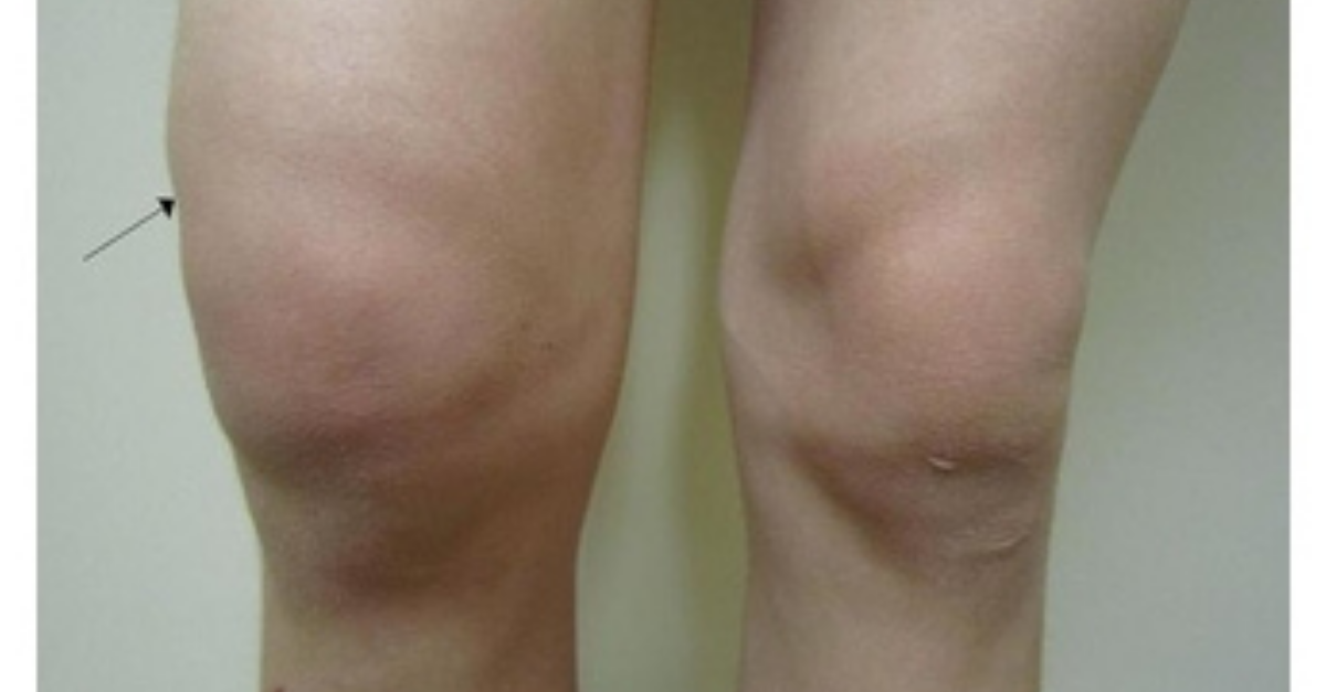 O que é sinovite — o que fazer quando as articulações estão rangendo