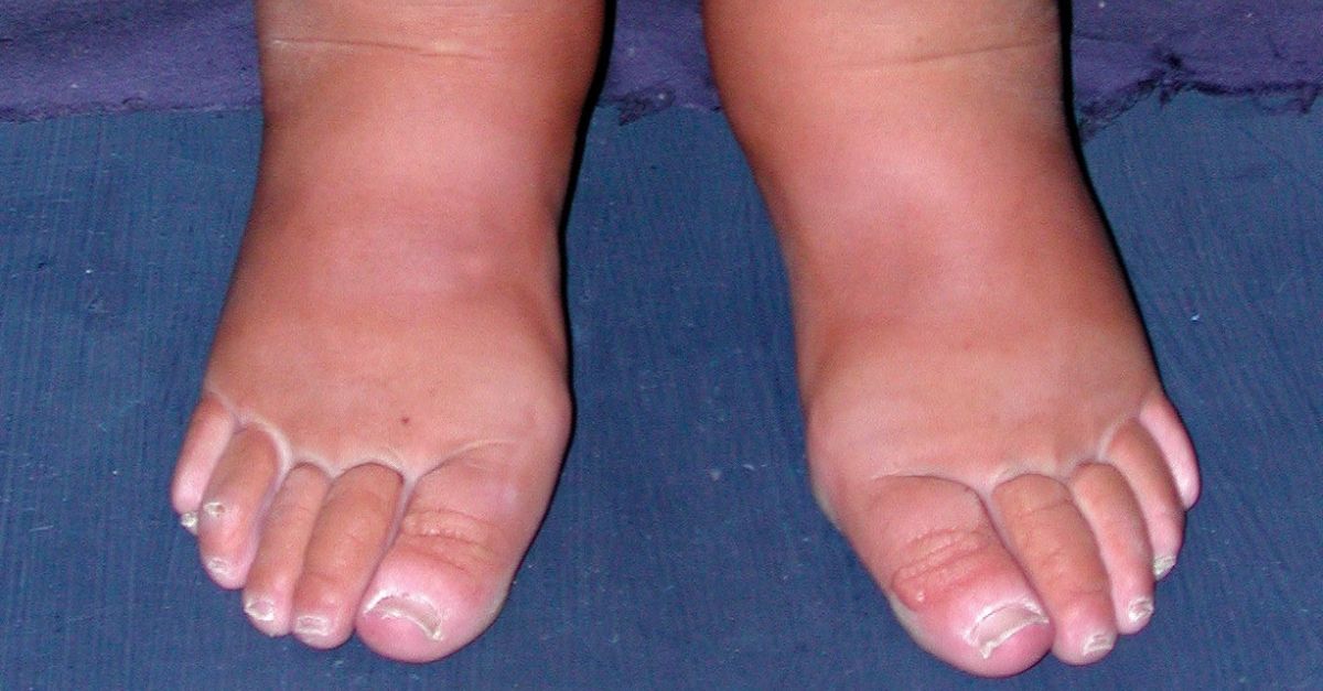 Linfedema: saiba o que é e como tratar esse problema vascular