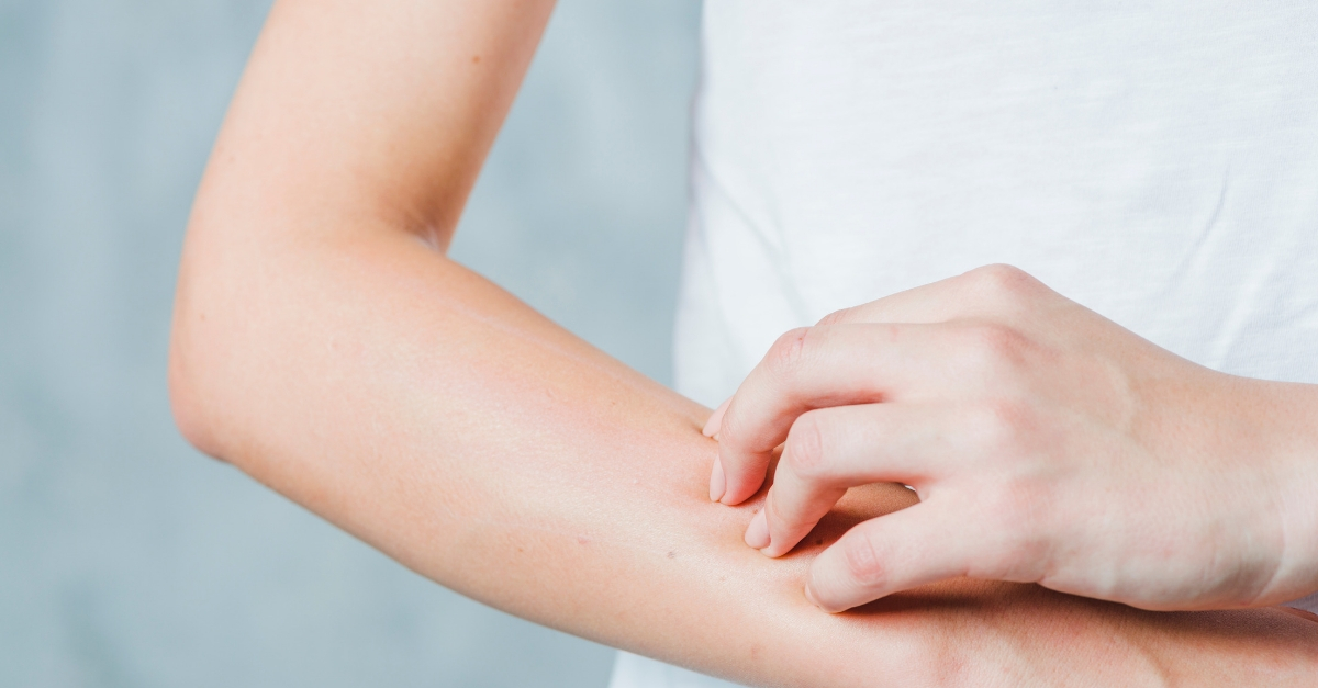 Urticária: tipos, causas e tratamento