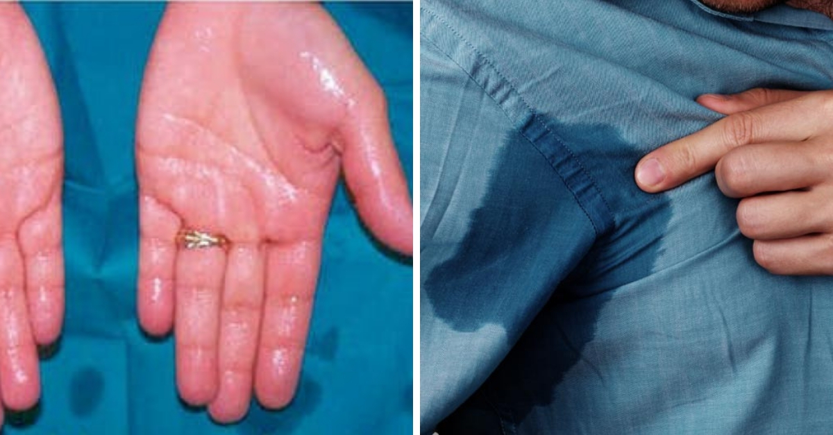 O que é, quais as causas e quais os tratamentos da sudorese excessiva?