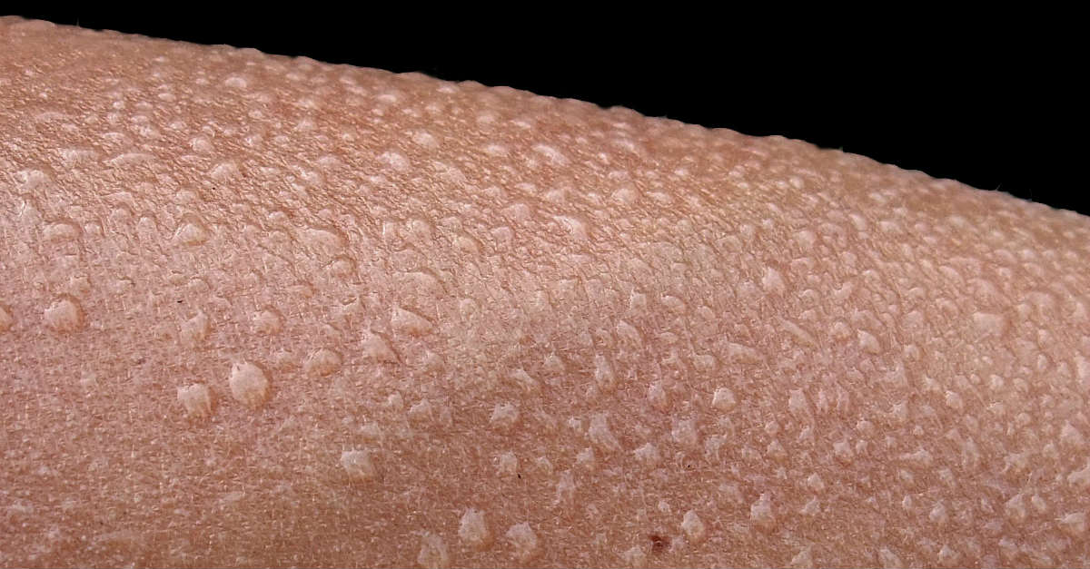 O que é, quais as causas e quais os tratamentos da sudorese excessiva?