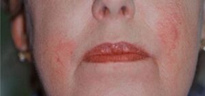 Telangiectasias: saiba o que causa esses vasinhos no rosto