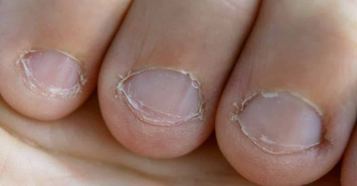 Como parar de roer as unhas