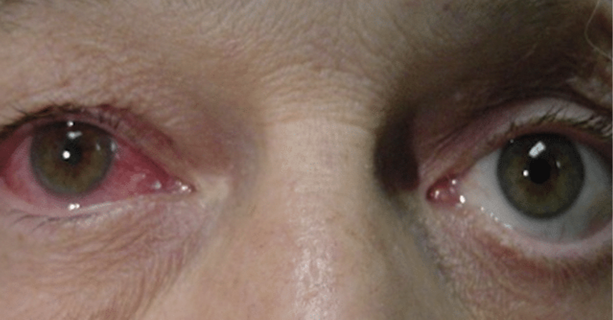 Uveíte: sintomas e como tratar essa doença que pode causar cegueira